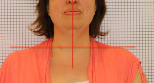 Adult Tongue Tie Surgery Changed My Life Dr Steven Lin